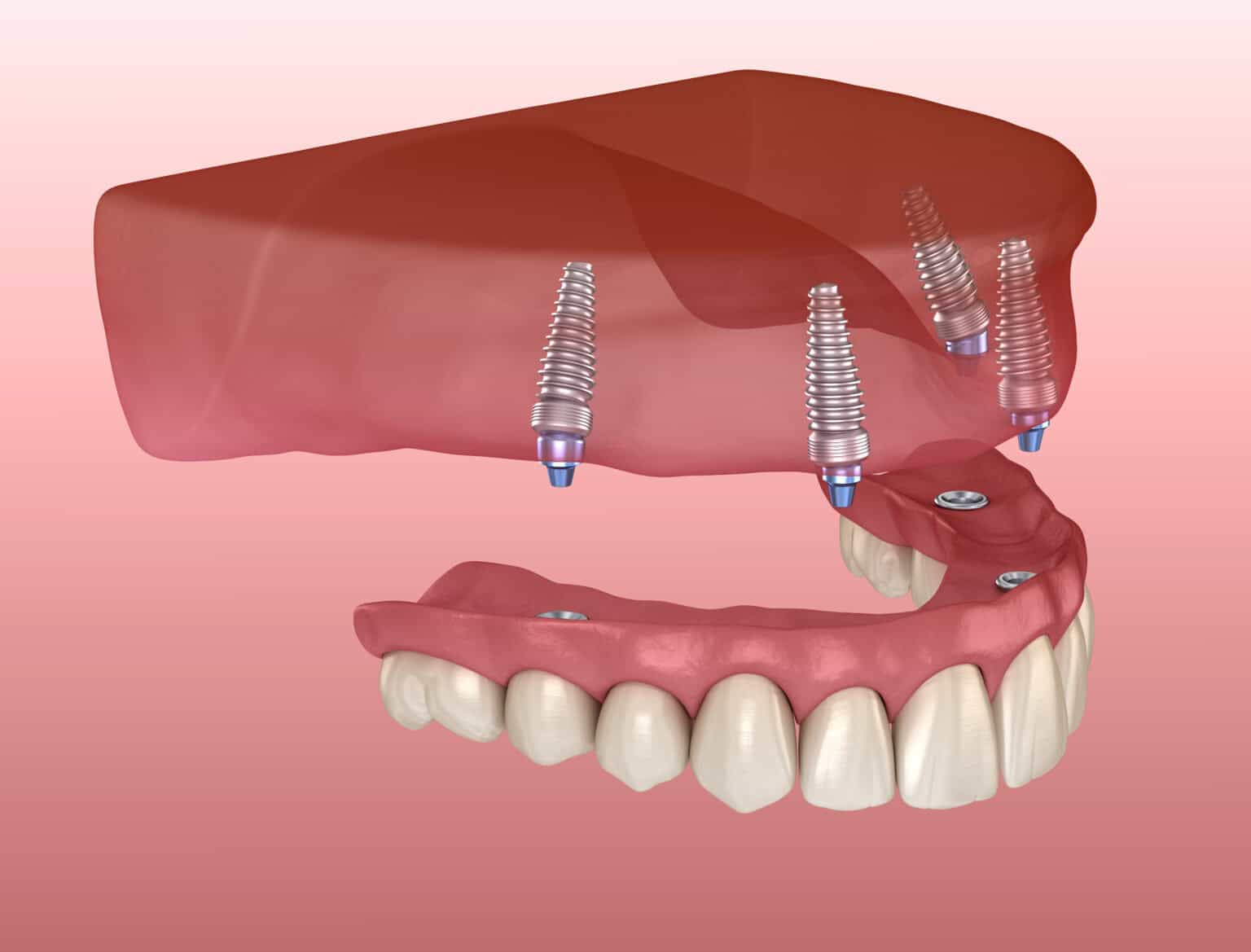 Complete Tooth Replacement Treatment in Suwanee, GA
