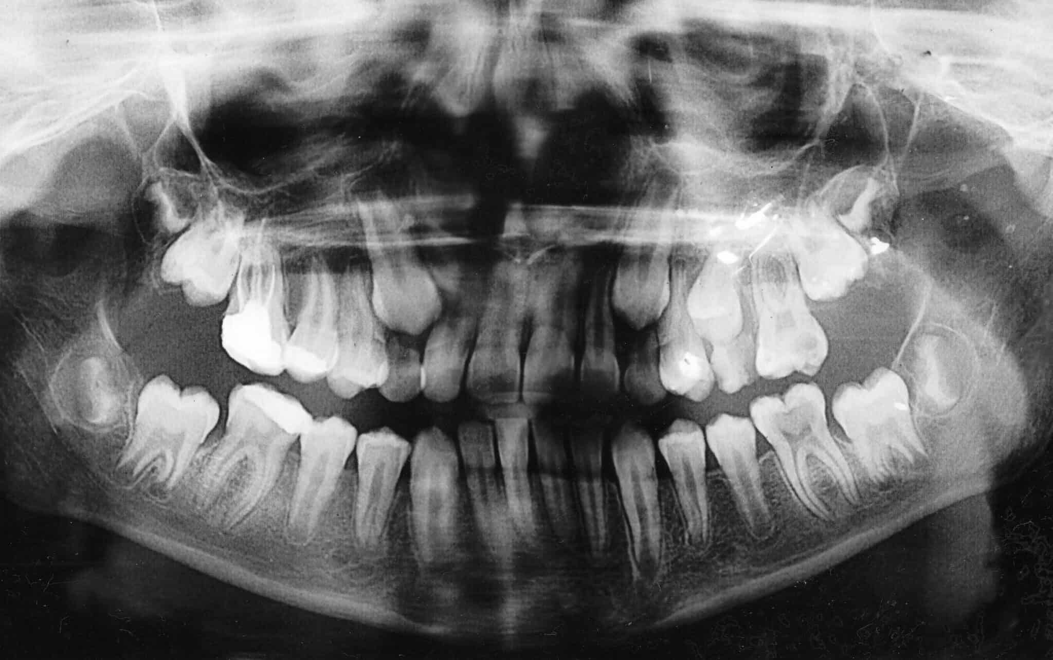 Impacted Canines Treatment in Suwanee, GA